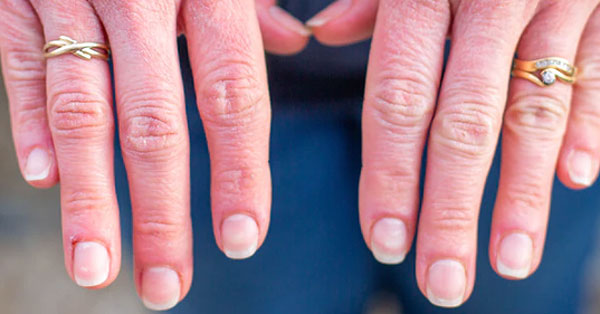 A "COVID-körmök" valóban a betegség tünetének számítanak? - WEBBeteg