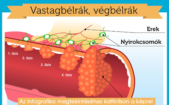 A vastagbéldaganat és a végbélrák (infografika) - Médiatár - WEBBeteg